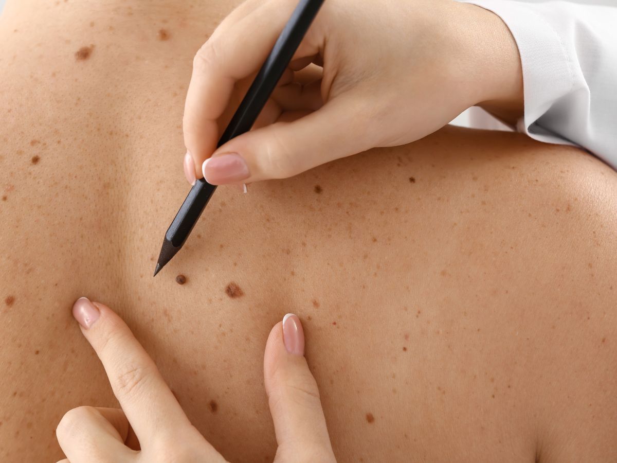 Identificación temprana de los síntomas del cáncer de piel