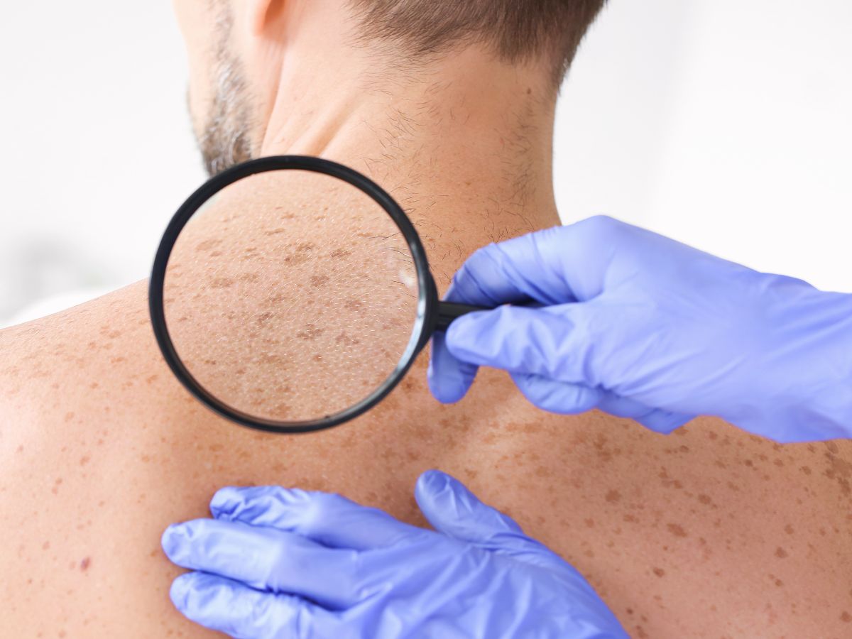 Understanding Skin Cancer: A Guide for Seniors | All Seniors Foundation